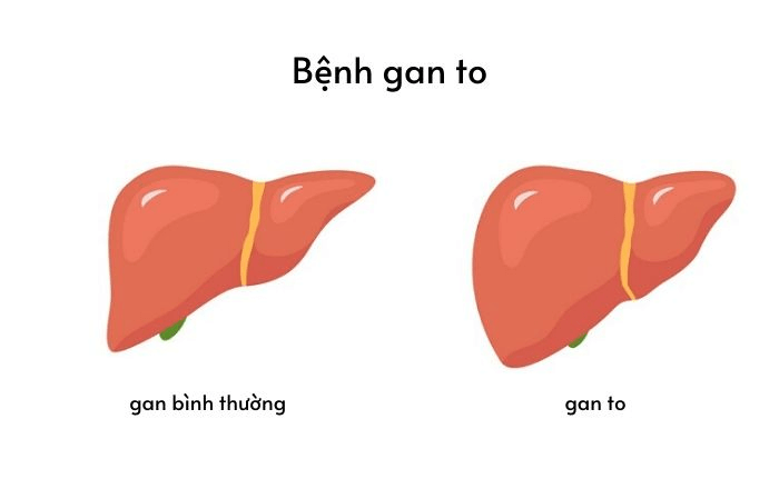 Gan to: Những điều cần biết và cách phòng ngừa