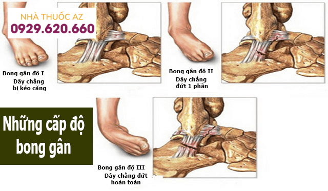 Bong gân chân: Nguyên nhân, triệu chứng và cách điều trị khi gặp