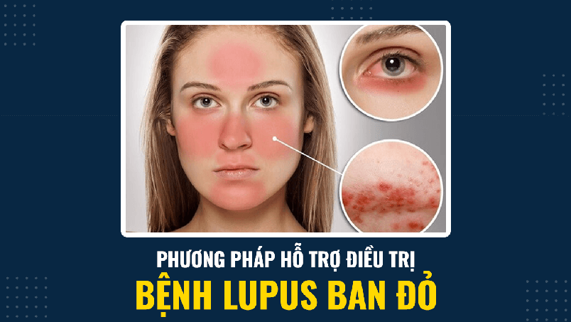 LUPUS BAN ĐỎ: Những điều cần biết và cách phòng ngừa