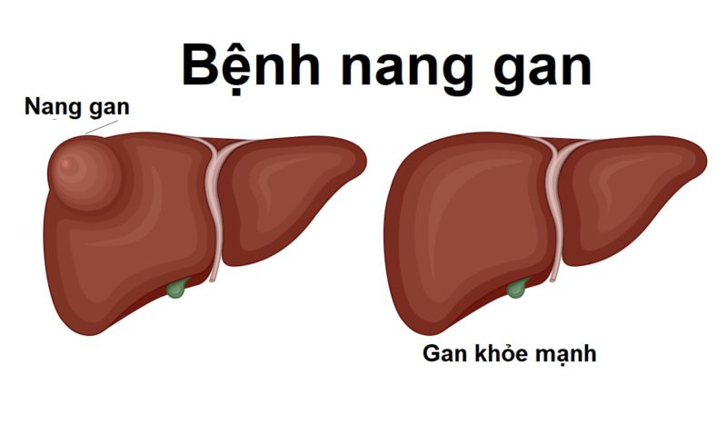 Nang gan: Những điều cần biết và cách phòng ngừa